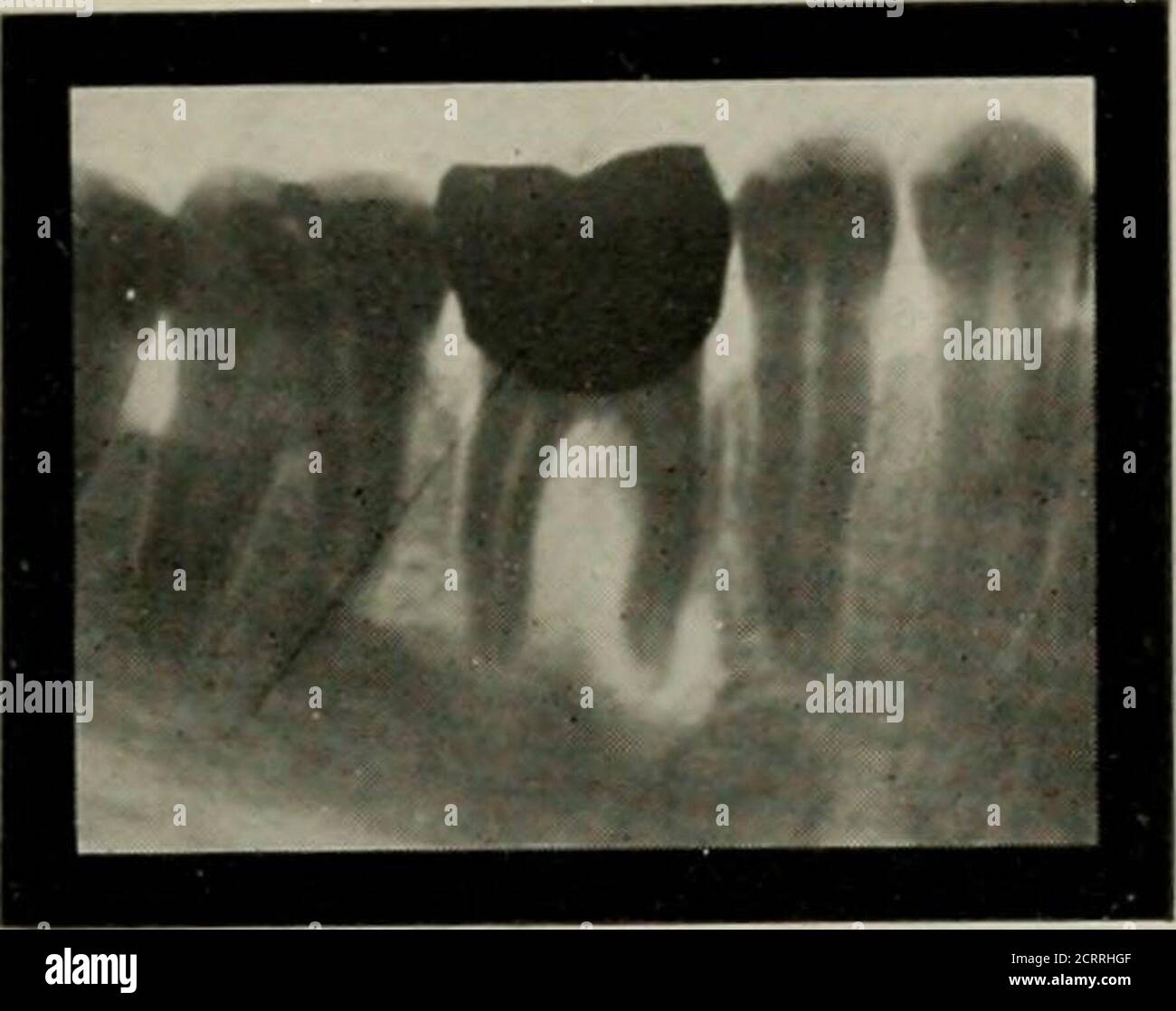 Apical foramen of root of tooth hi-res stock photography and images - Alamy