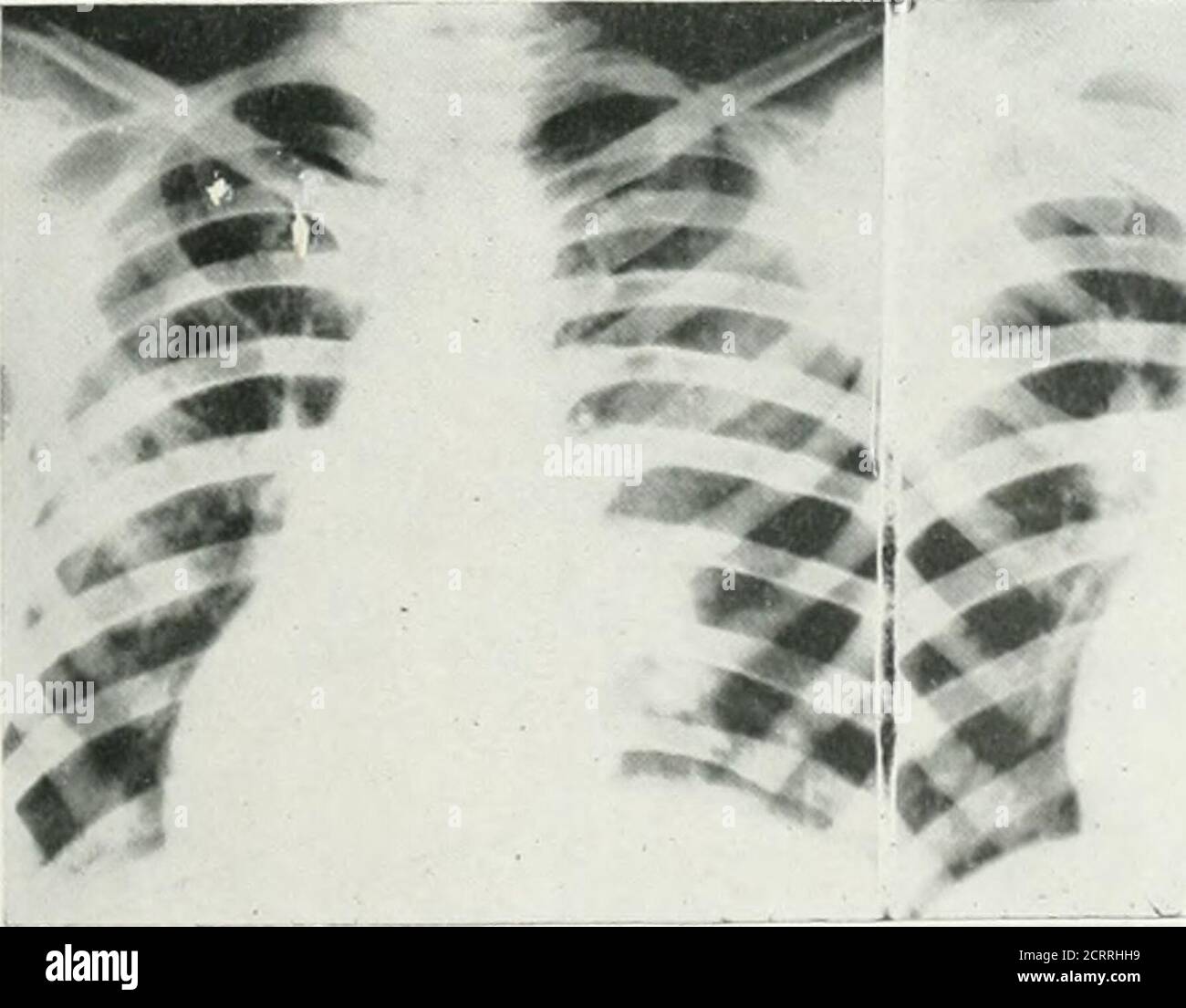 Subphrenic abscess hi-res stock photography and images - Alamy