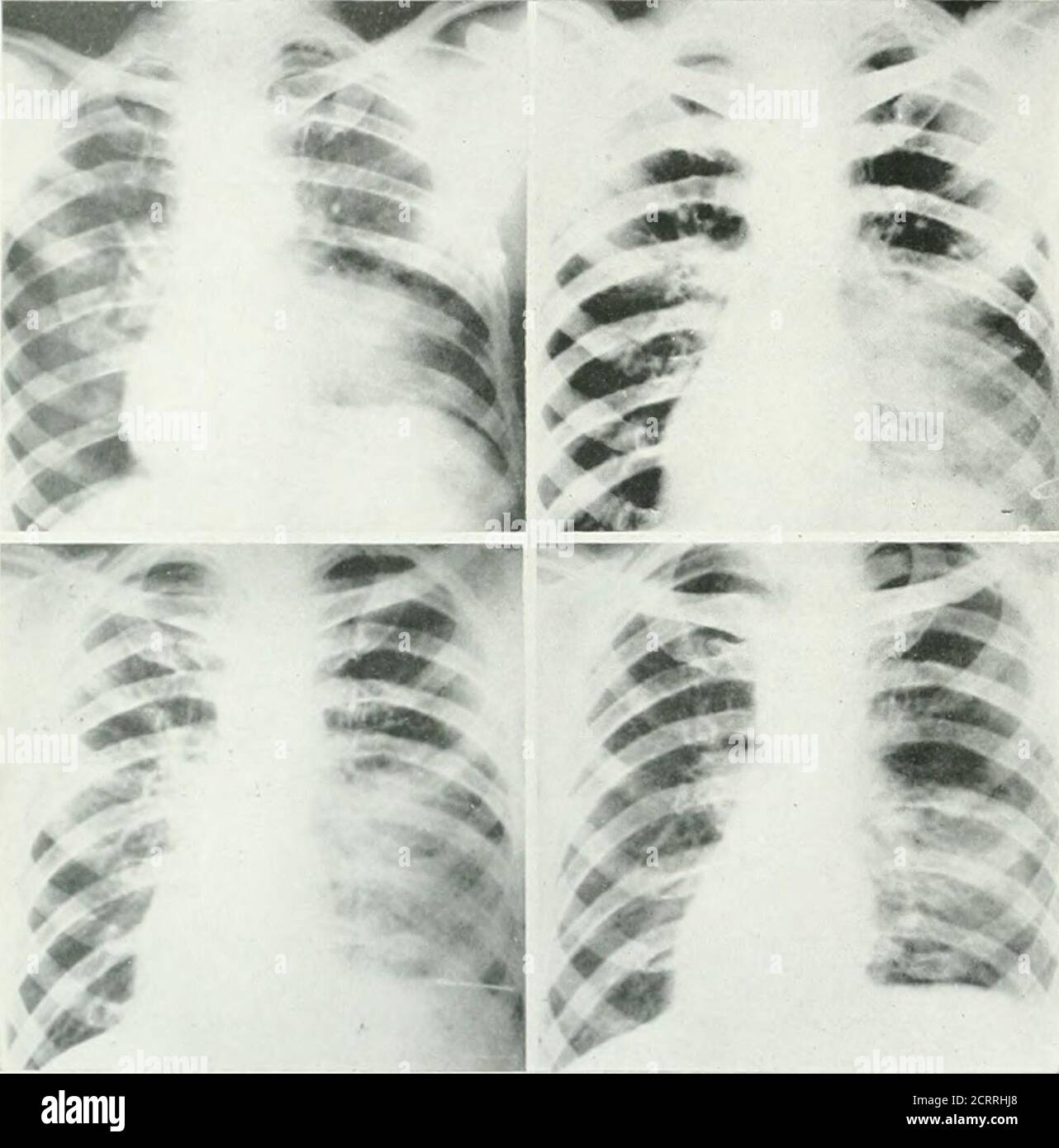 Abscess tonsil hi-res stock photography and images - Alamy