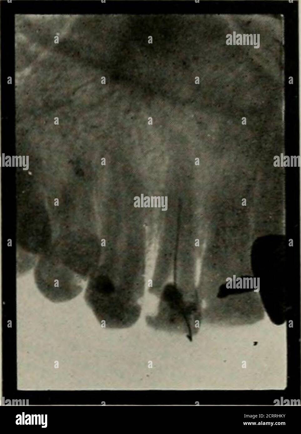 Apical Foramen