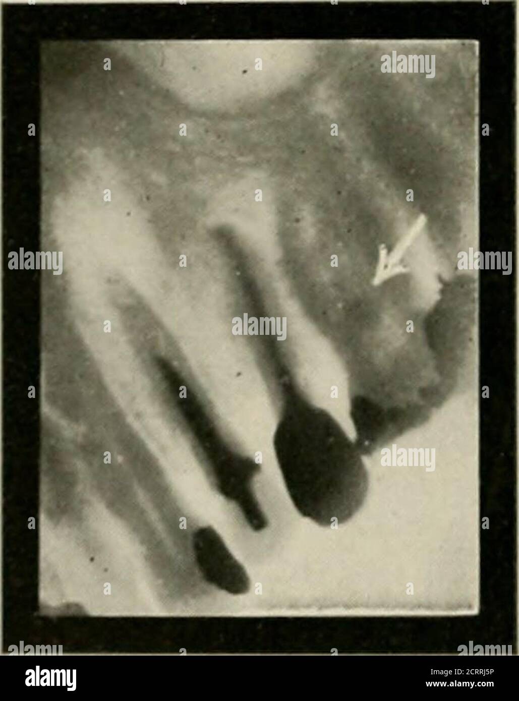 . Elementary and dental radiography . Fig. 17.). The upper arrow points ...