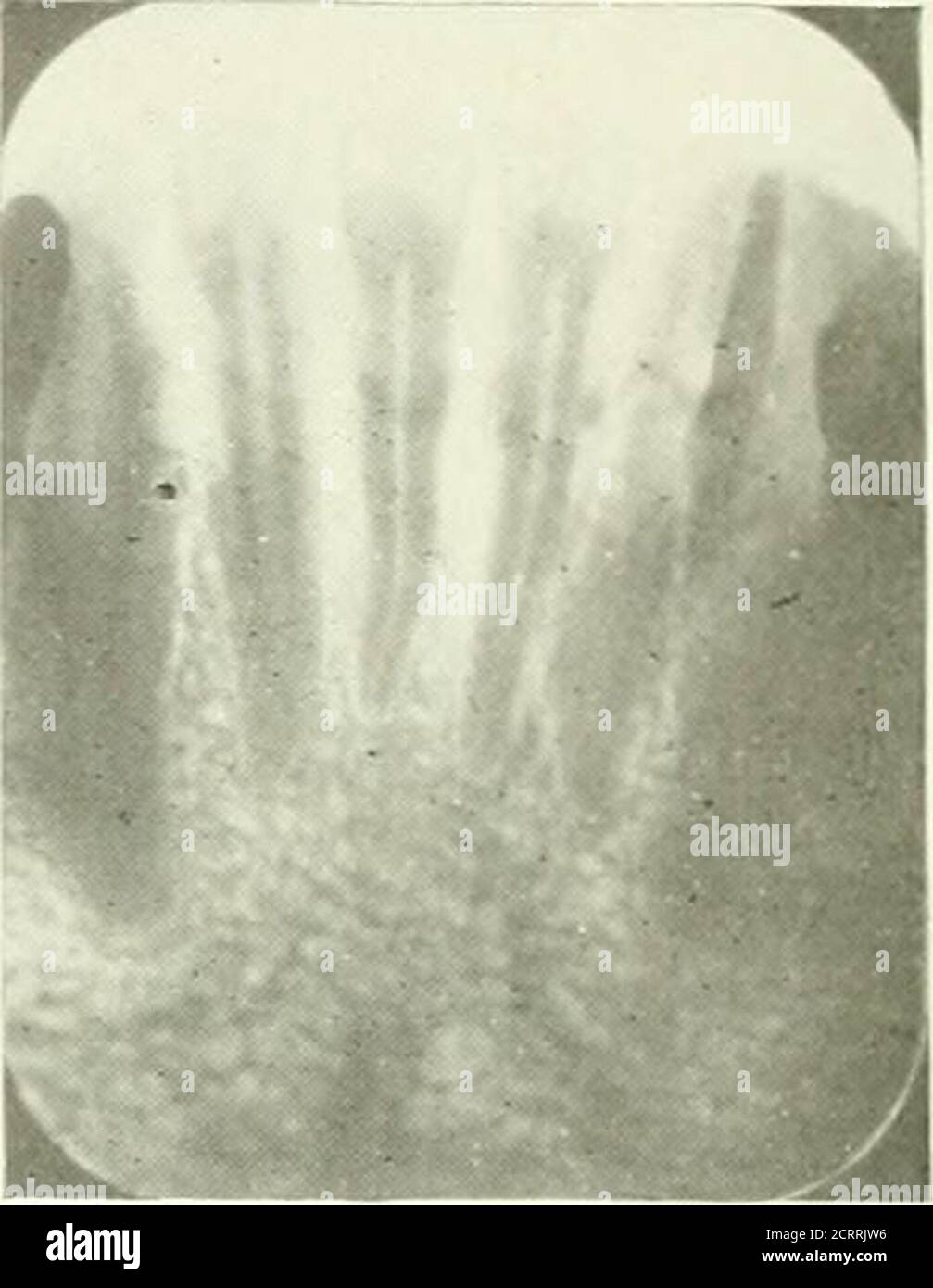 . Roentgenographic diagnosis of dental infection in systemic diseases ...