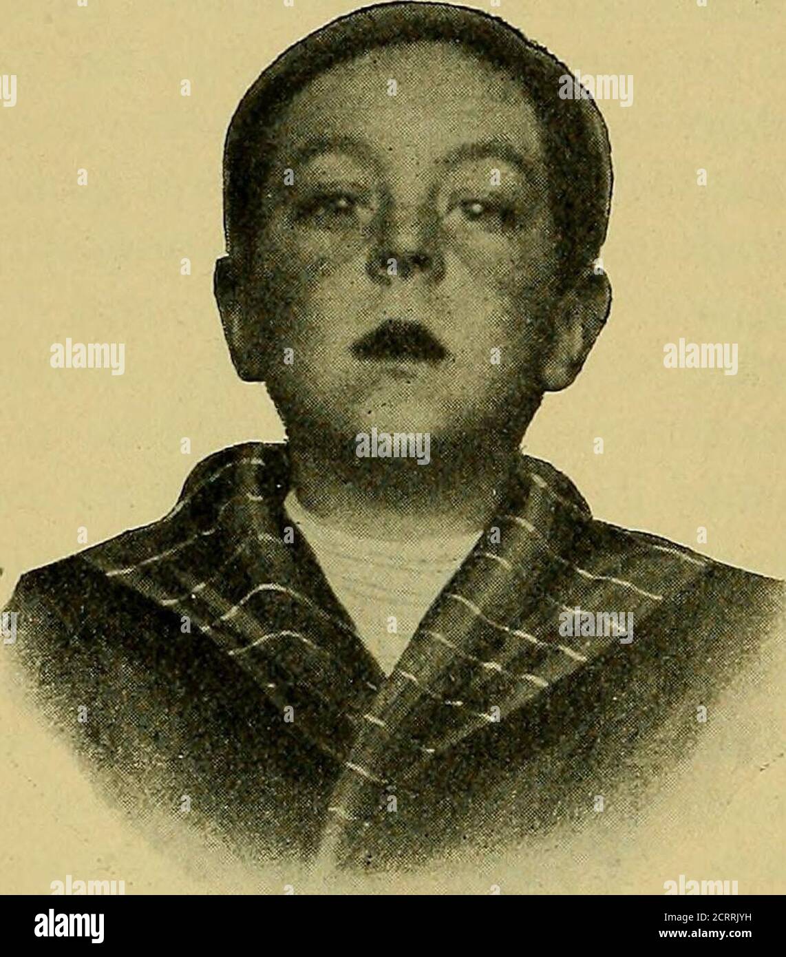 Hereditary syphilis hi-res stock photography and images - Alamy