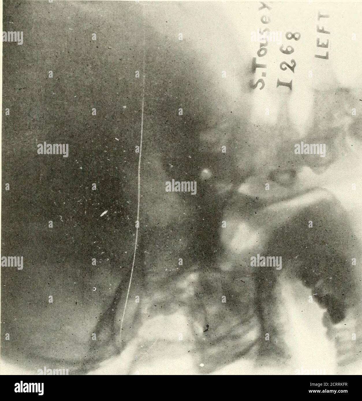 . Roentgenographic diagnosis of dental infection in systemic diseases ...