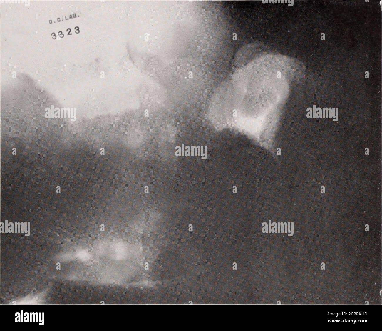 . Journal of radiology . Case 42. No. 4393The illustration is a lateral ...