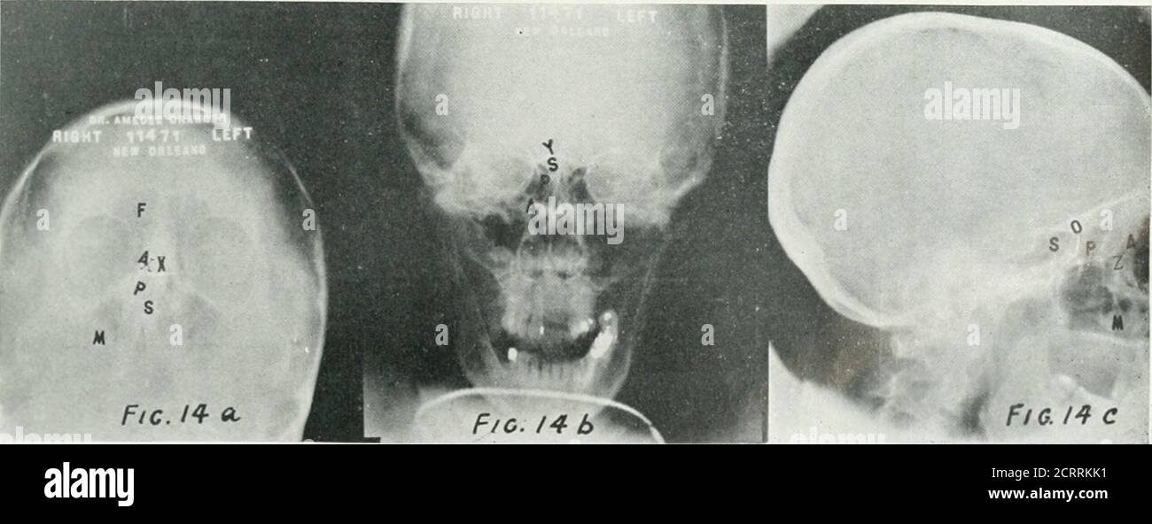 . Archives of physical medicine and rehabilitation . Fig. 13—Chronic ...