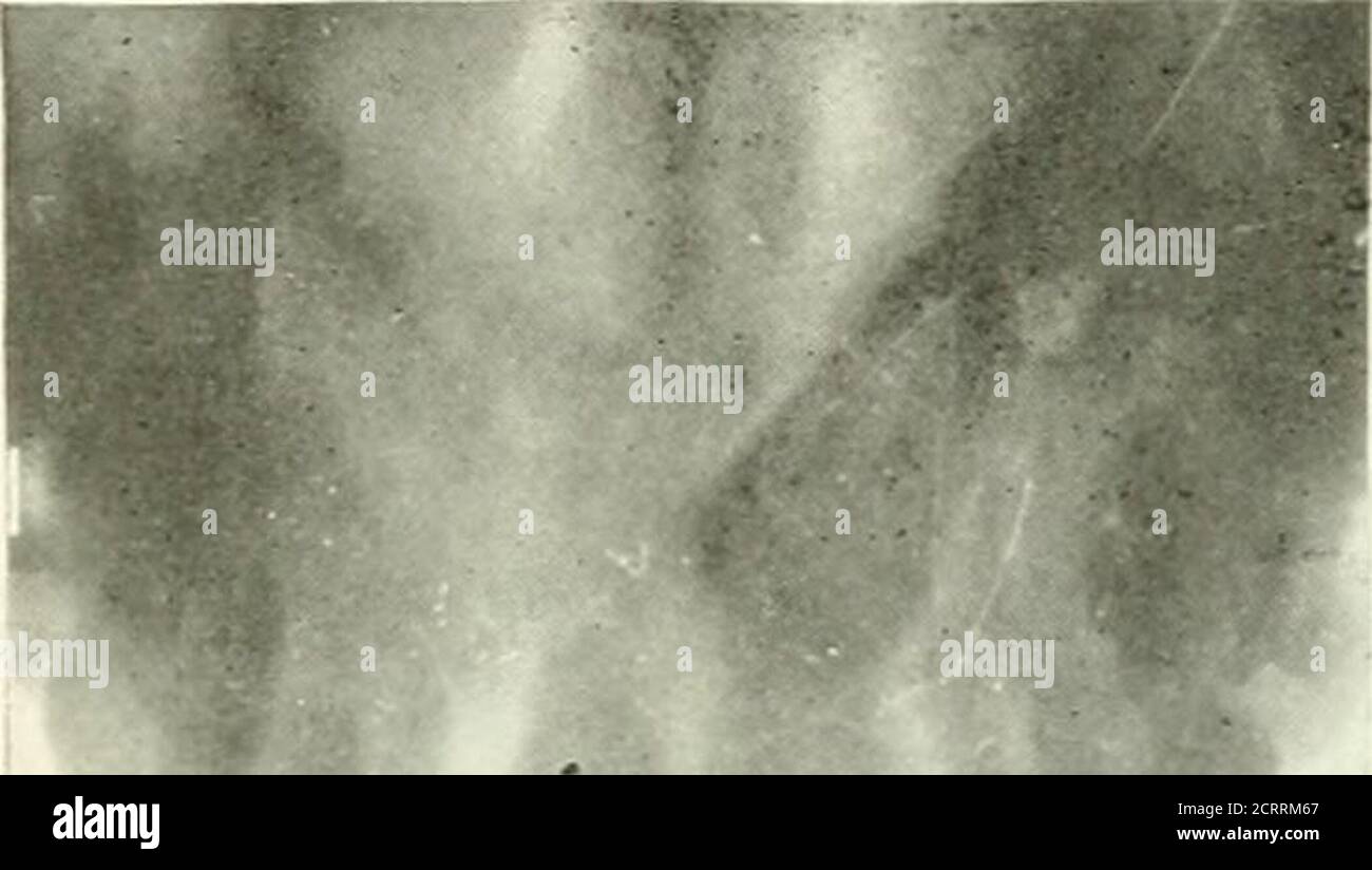 . Roentgenographic diagnosis of dental infection in systemic diseases ...