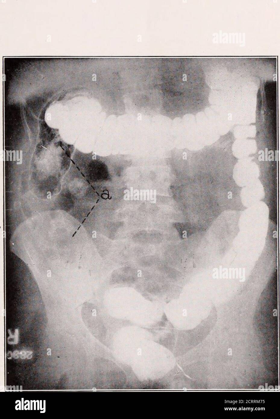 X ray burns hi-res stock photography and images - Alamy