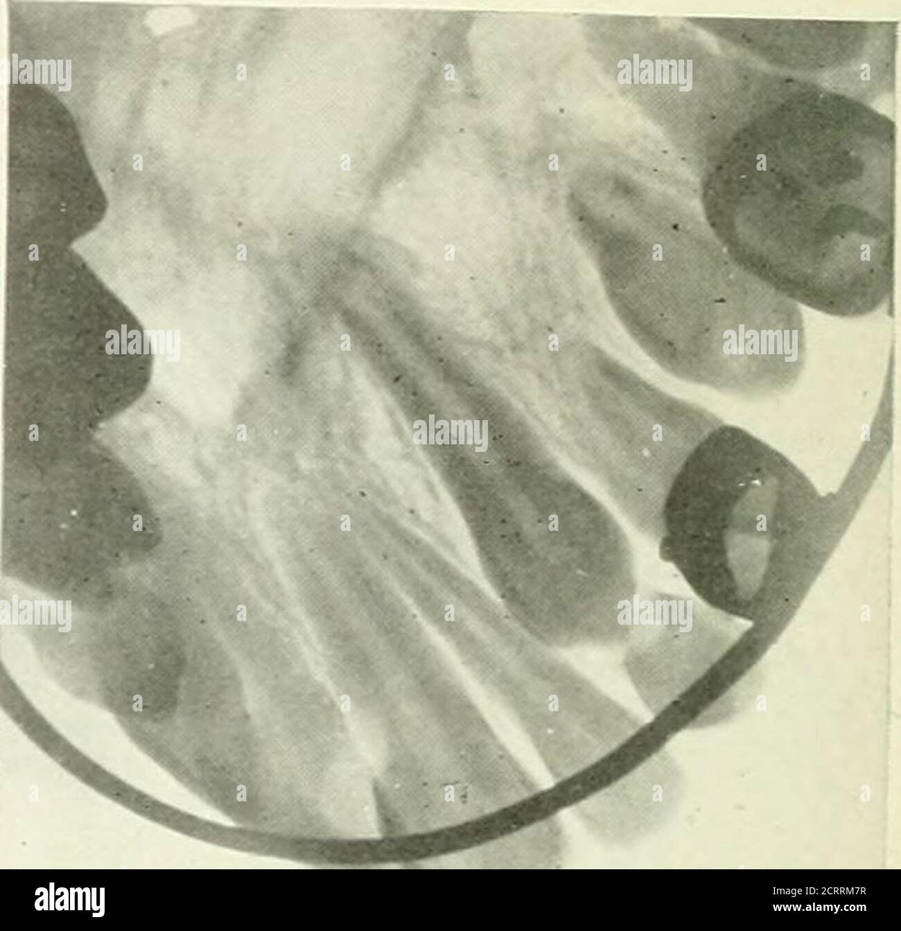 . Roentgenographic diagnosis of dental infection in systemic diseases ...