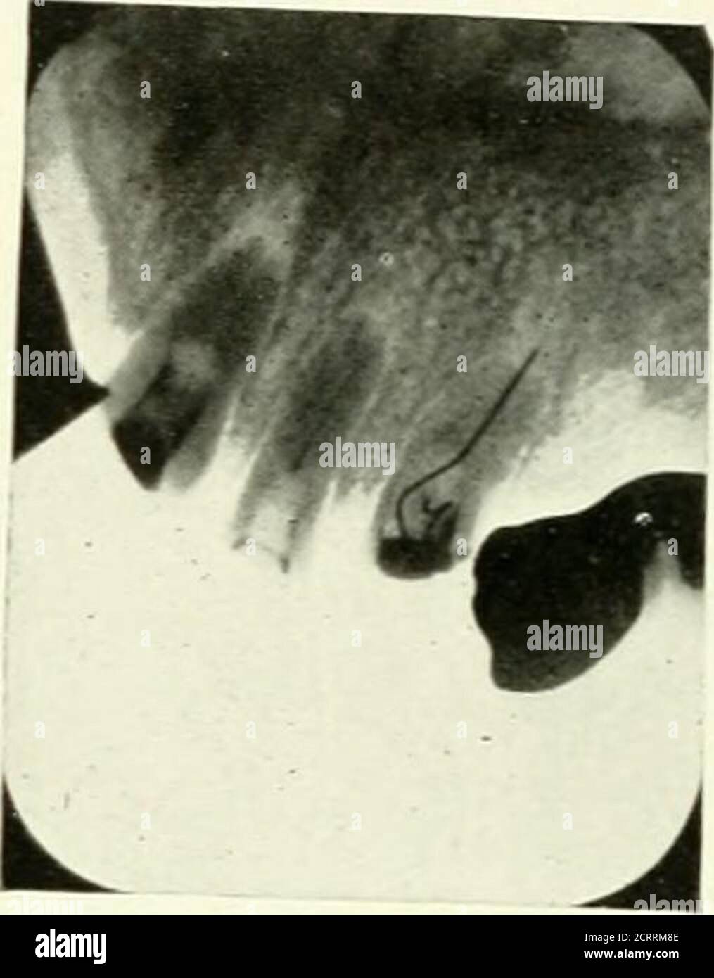 Suppuration High Resolution Stock Photography and Images - Alamy