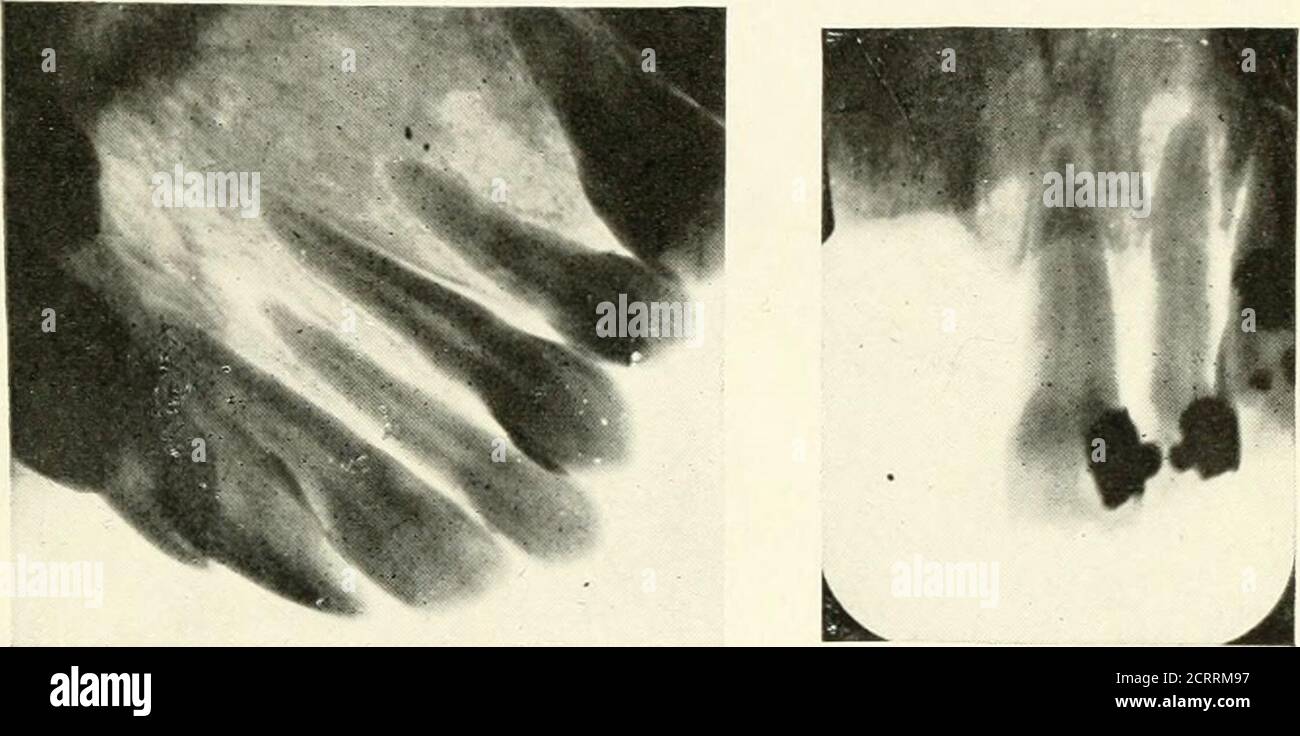 Bookidroentgenogra hi-res stock photography and images - Alamy