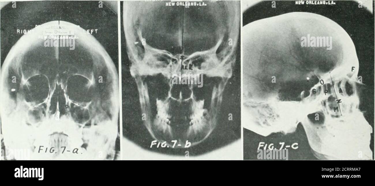 . Archives of physical medicine and rehabilitation . Fig. 6—Skull C ...