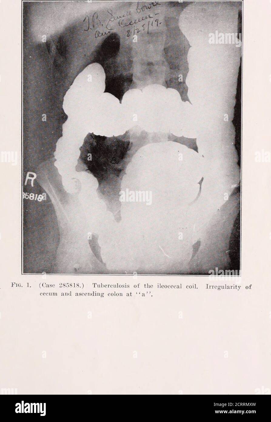 . Journal of radiology . ed dilatation and writhing of the duo-denum ...