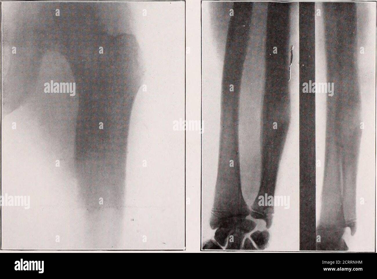 . Journal of radiology . Fig. 80. Path. No. 11769. Syphilitic peri ...