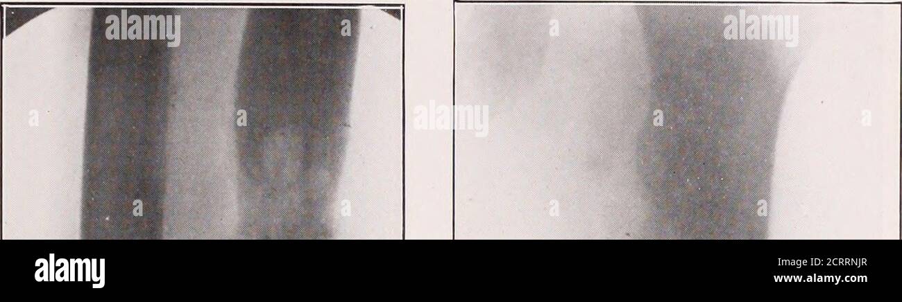 . Journal of radiology . Fig. 79. Path. No. 11769. Syphilitic ...