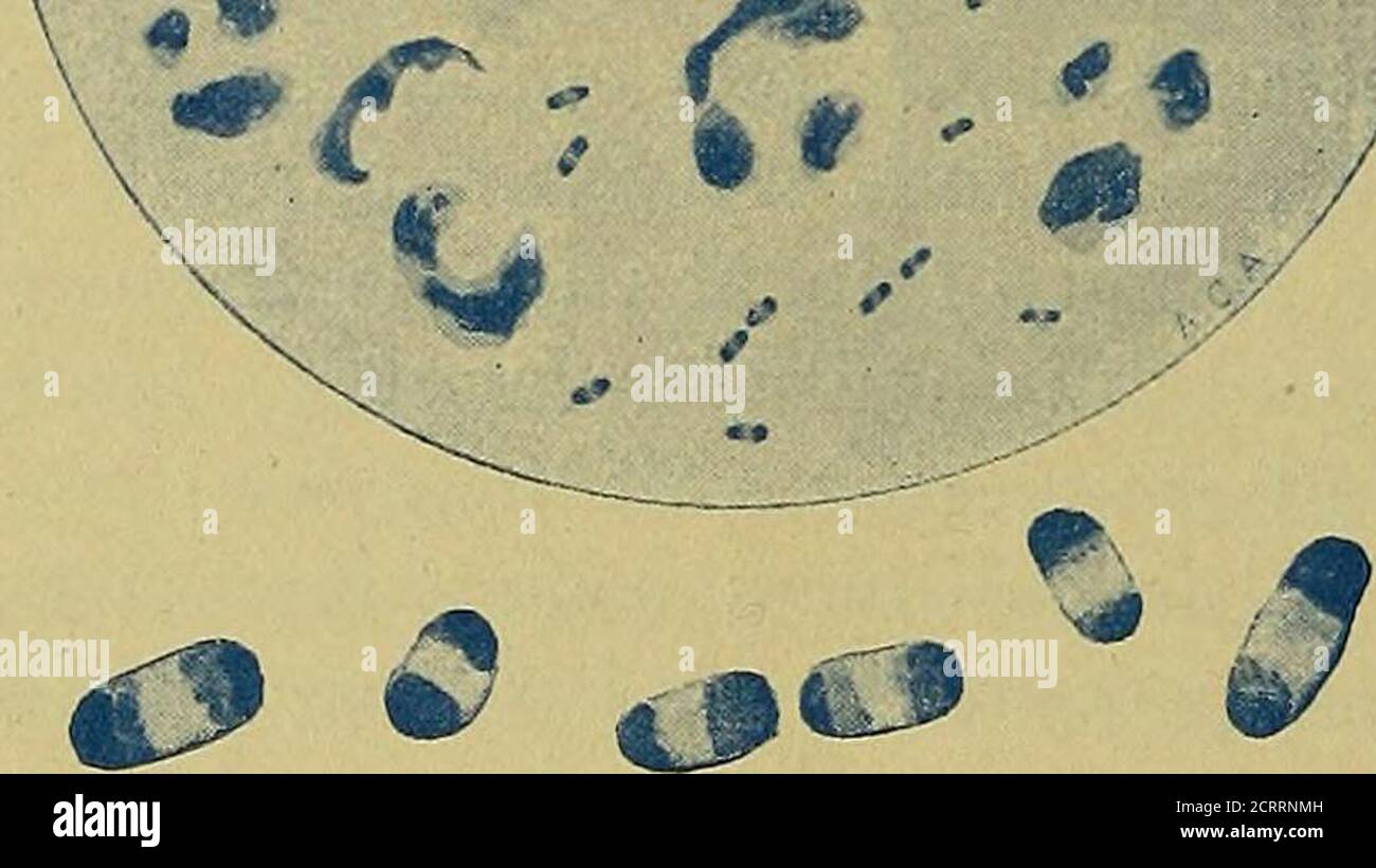 Buboes hi-res stock photography and images - Alamy