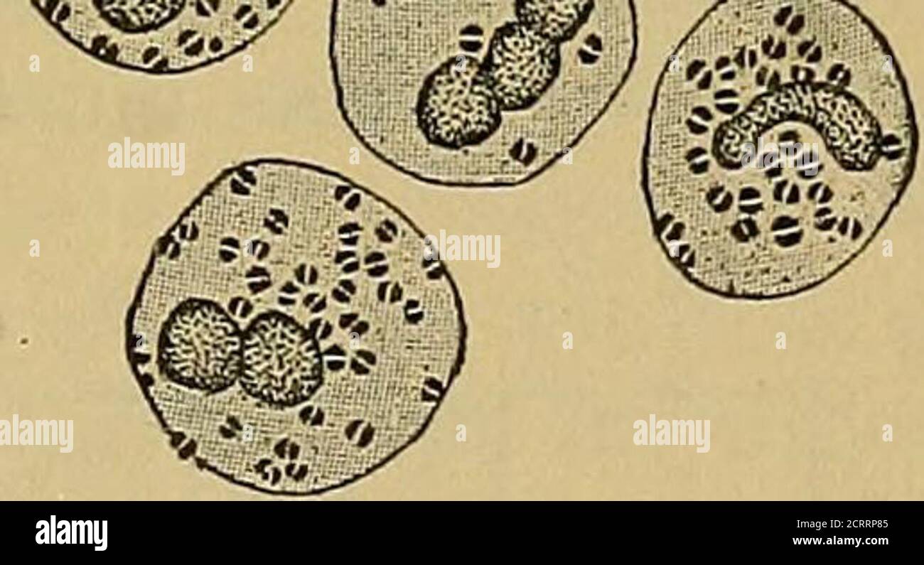 Pus lung hi-res stock photography and images - Alamy