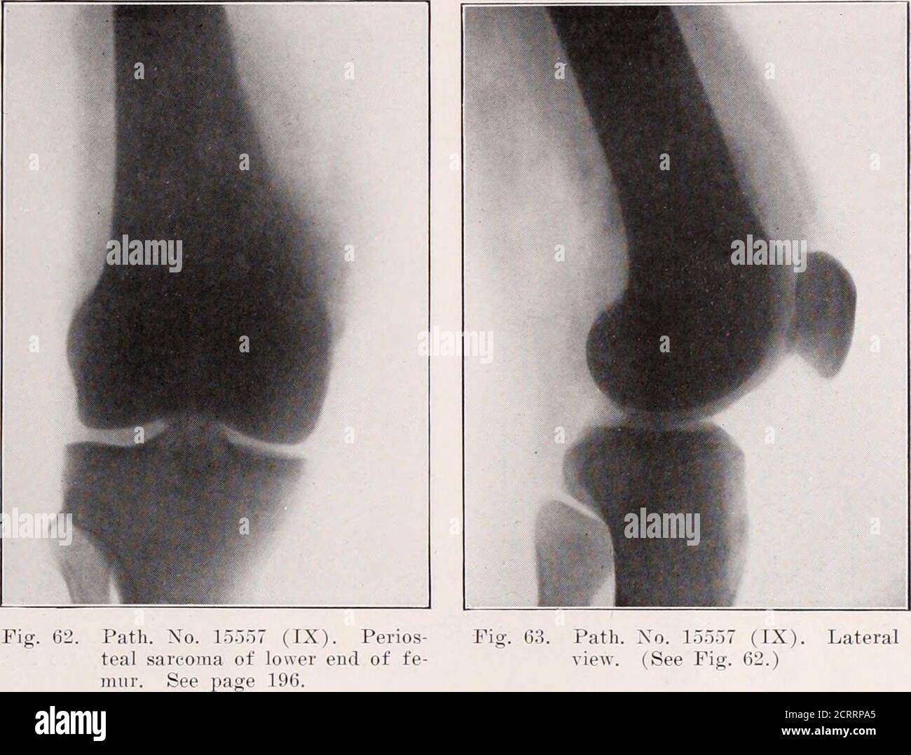 . Journal of radiology . Fig. 60. Path. No. 10693 (III). X-ray Fig. 61 ...