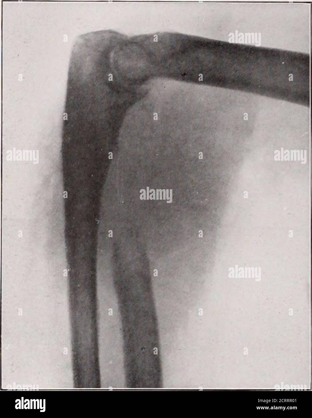 . Journal of radiology . Pig. 50. Path. No. 9025 (III). Benignhone cyst ...