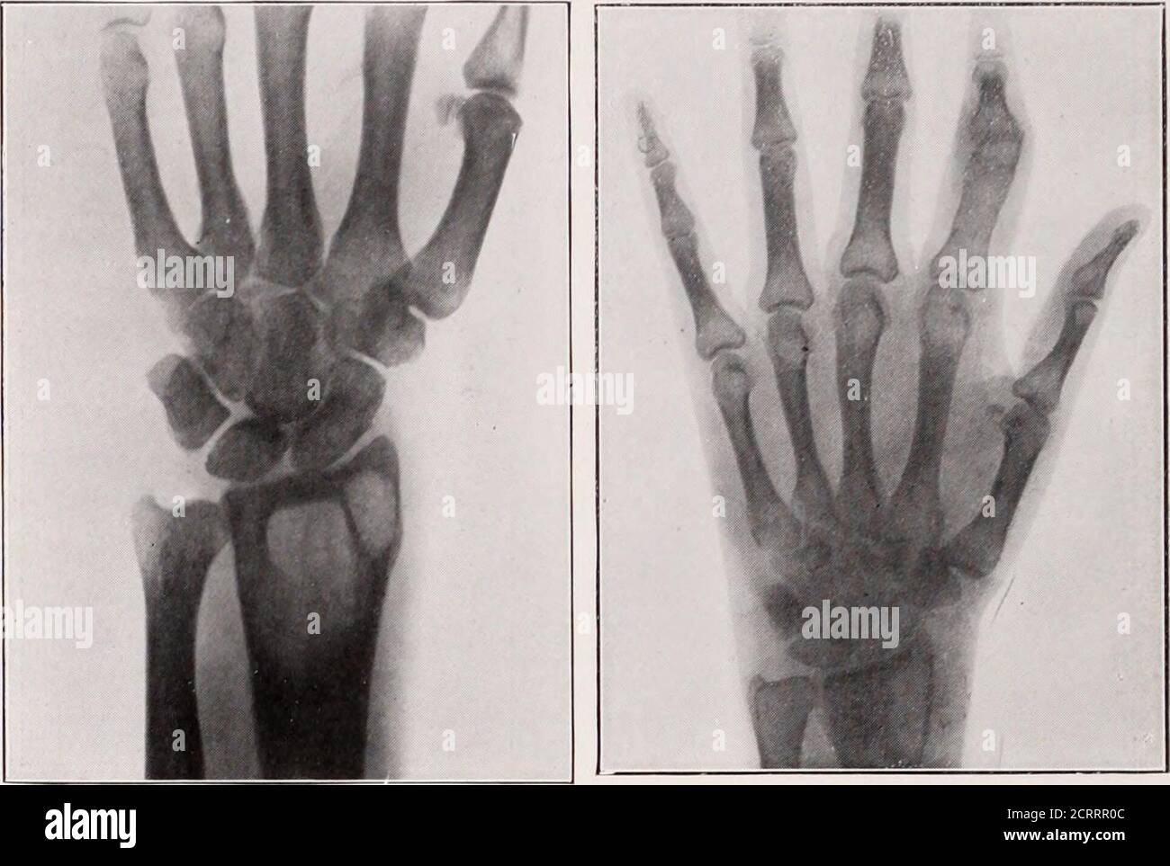 Ostitis fibrosa hi-res stock photography and images - Alamy