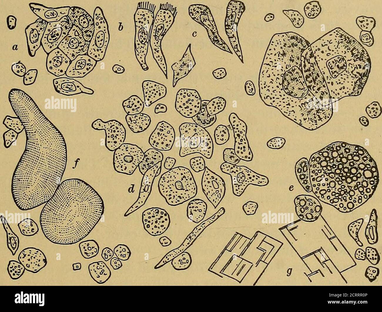 Cysts kidney hi-res stock photography and images - Alamy
