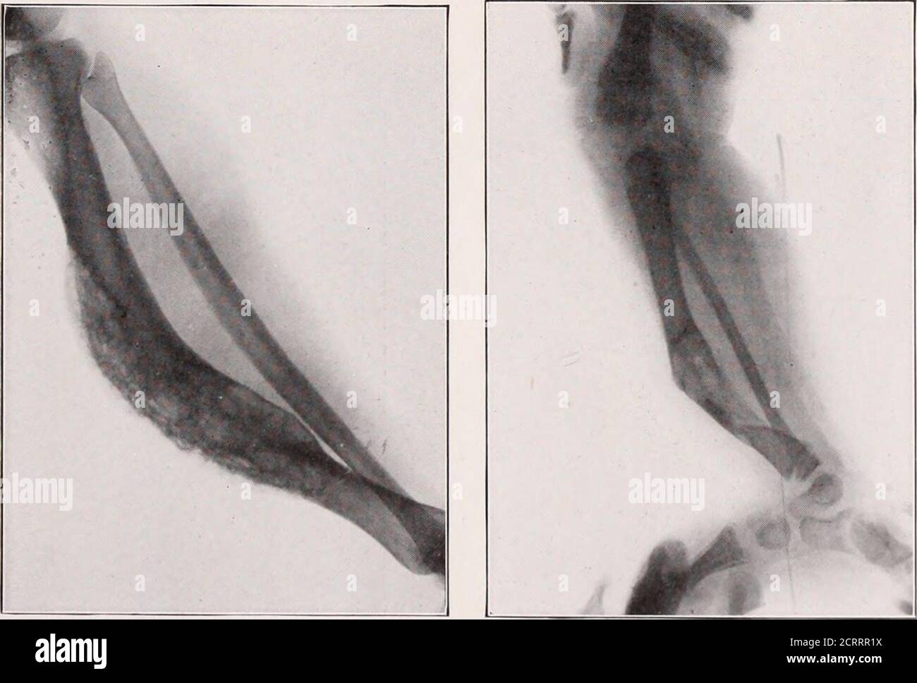 Ostitis fibrosa hi-res stock photography and images - Alamy