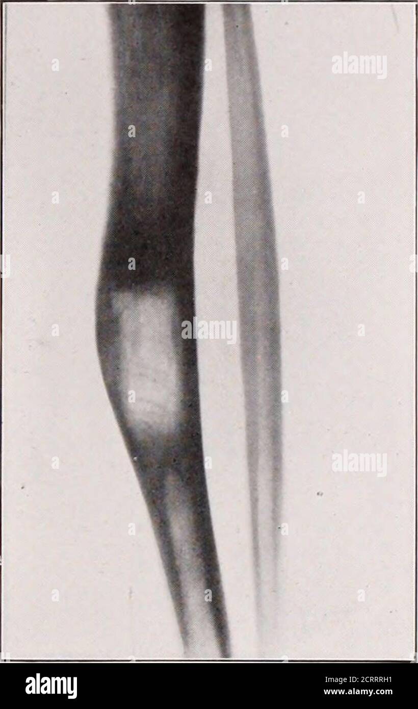 Ostitis fibrosa hi-res stock photography and images - Alamy