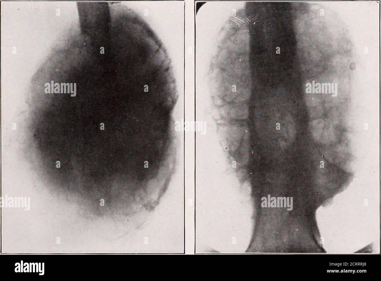 . Journal of radiology . Pig. 12. Path. No. 20115 (XIII). Malignant ...