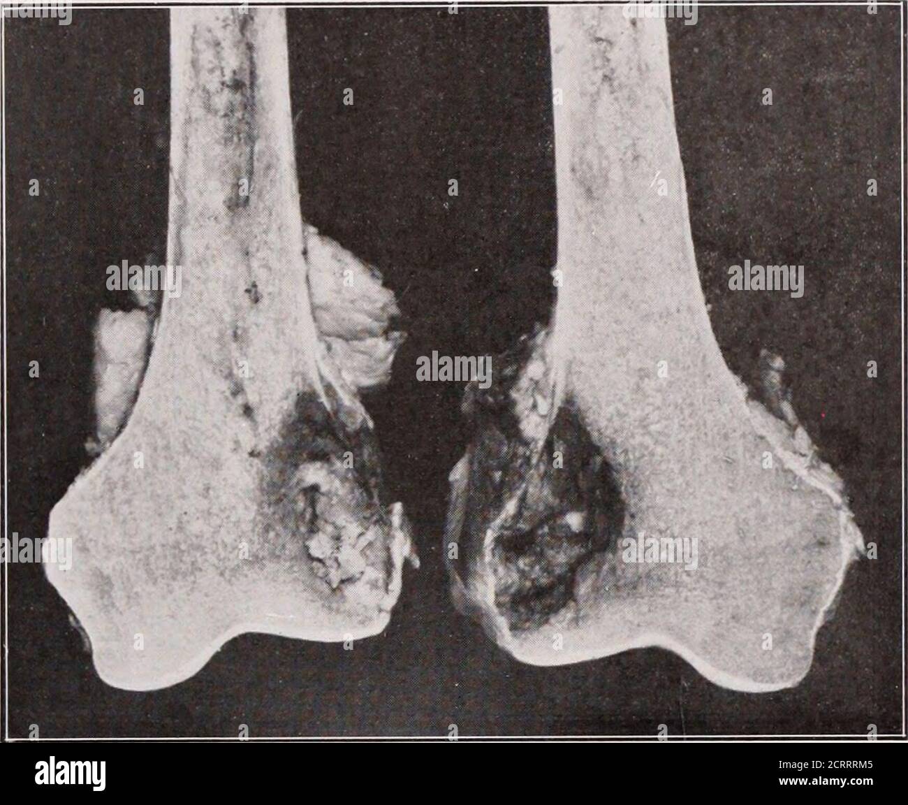. Journal of radiology . Fig. 10. Path. No. 9881 (V). Central Giant ...
