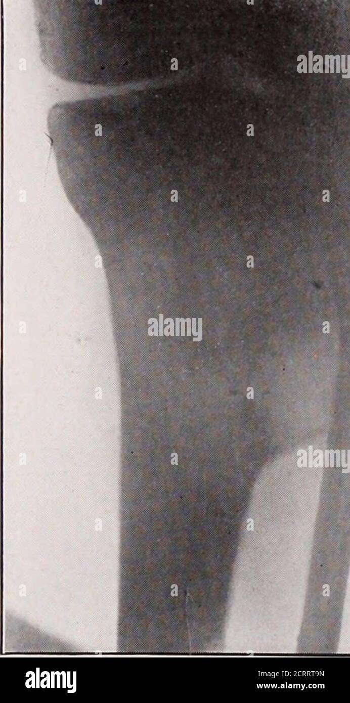 . Journal of radiology . Fig. 5. Path. No. 16297 (III). BenignBone Cyst ...