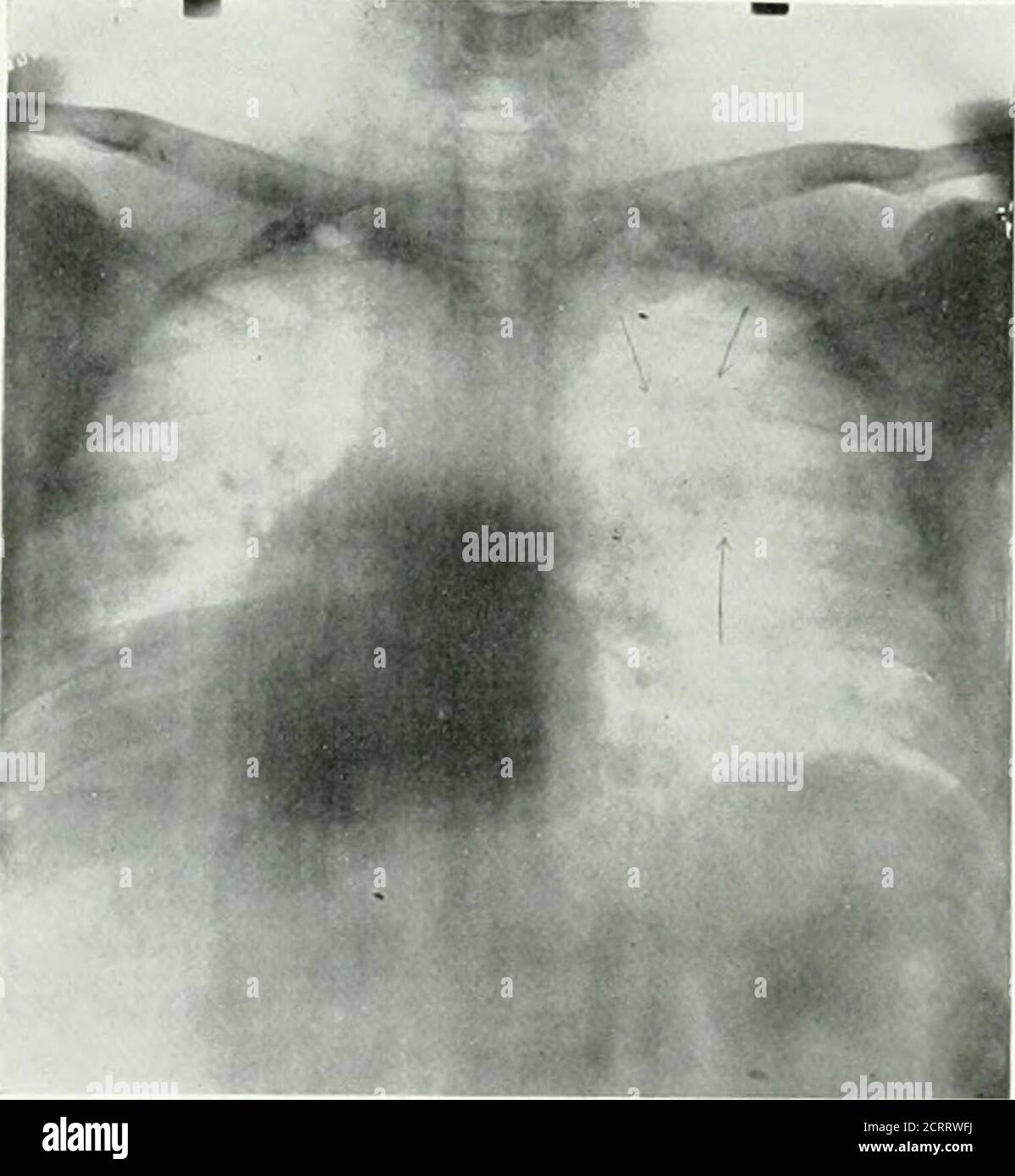 Lung hemorrhage hi-res stock photography and images - Alamy
