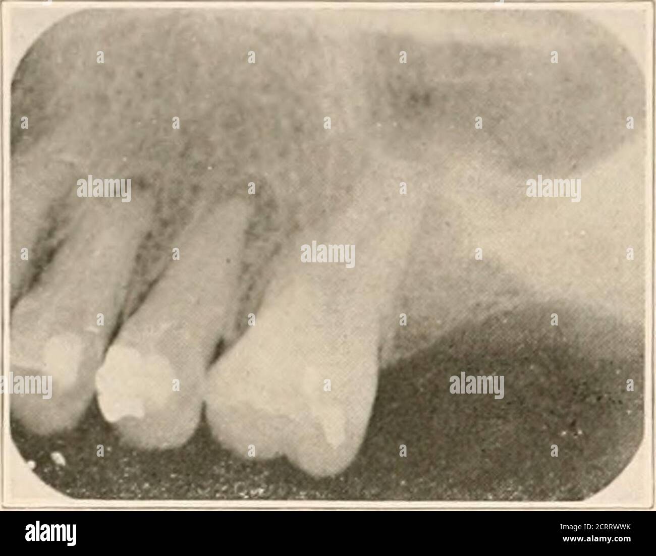 Apical foramen of root of tooth hi-res stock photography and images - Alamy