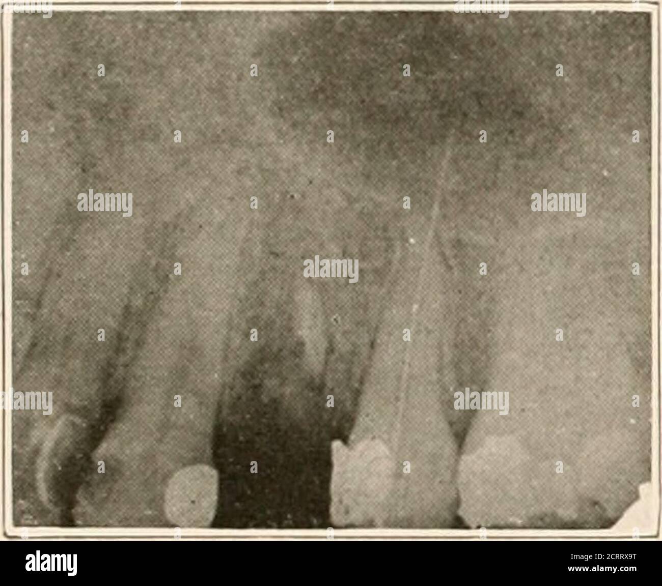 Root canal filling material hi-res stock photography and images - Alamy