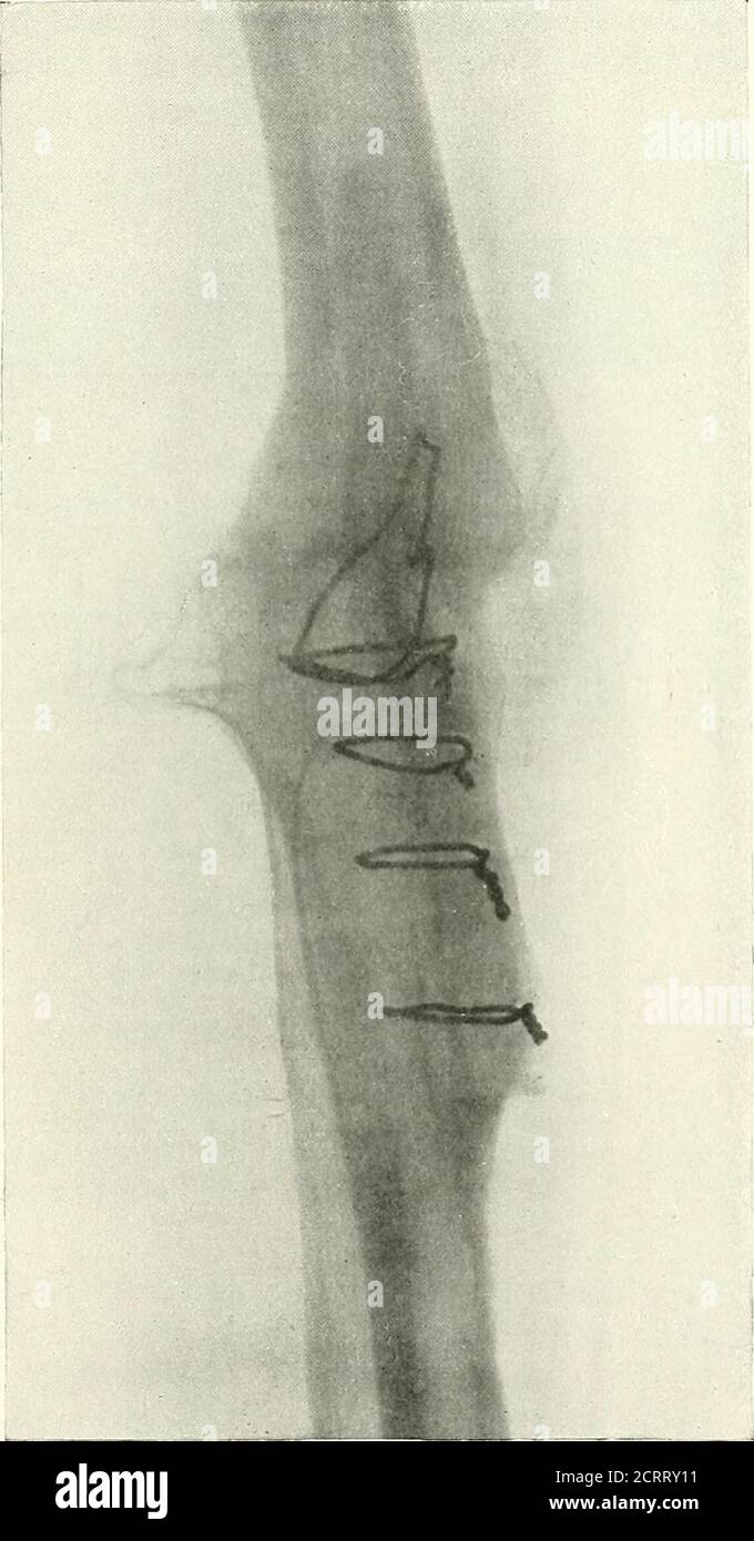 . On modern methods of treating fractures . Fig. 134.—Bone-graft for ...