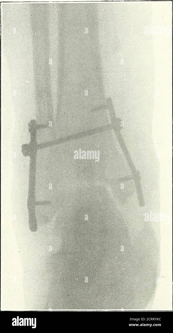 Malleolar fracture hi-res stock photography and images - Alamy