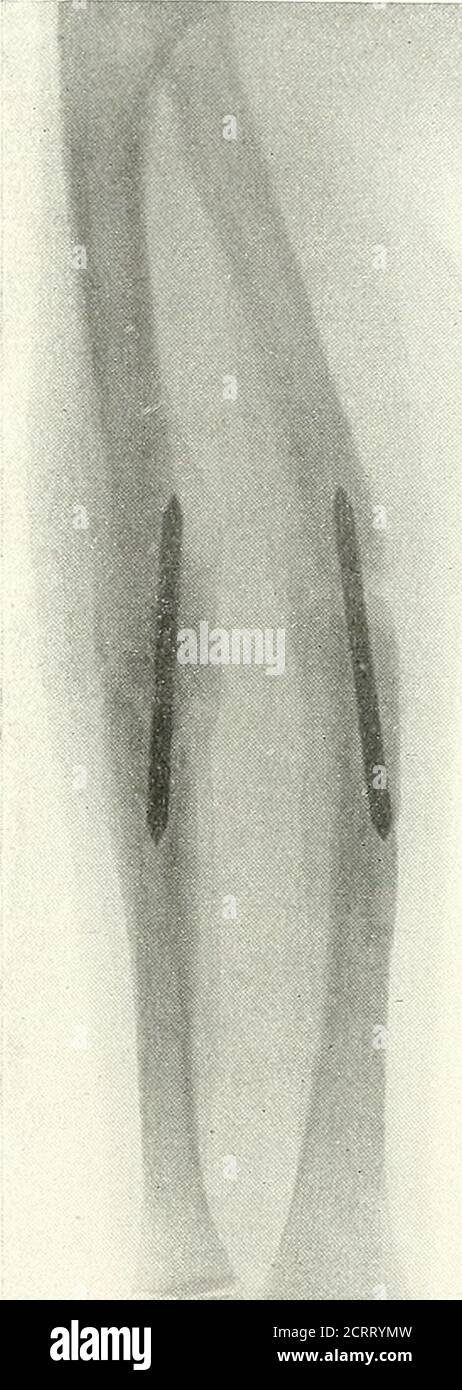 . On modern methods of treating fractures . or | in. thick, andtheir ...