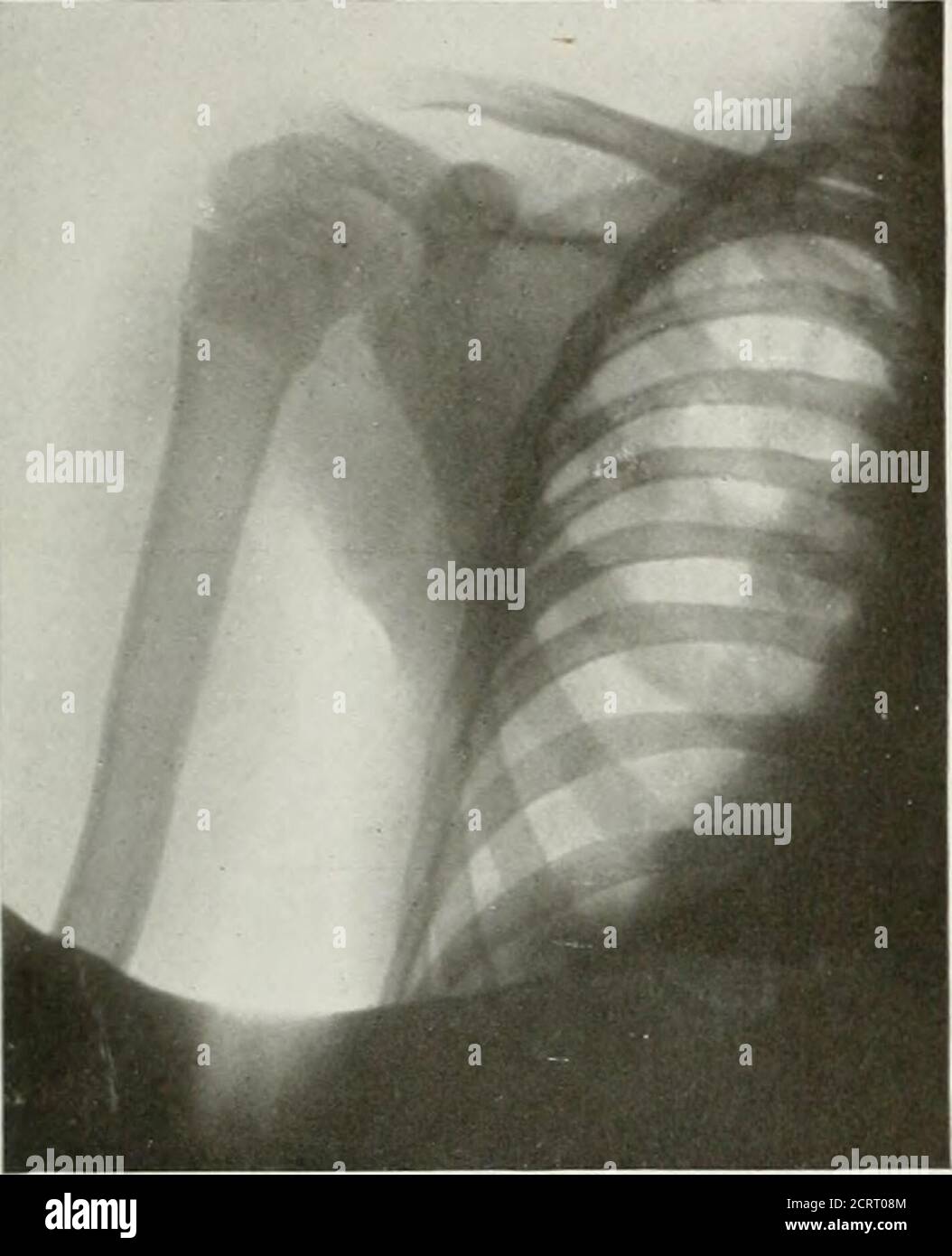 Subperiosteal hand hi-res stock photography and images - Alamy