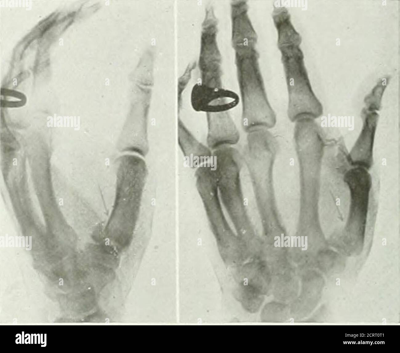 Metacarpal dislocation hi-res stock photography and images - Alamy