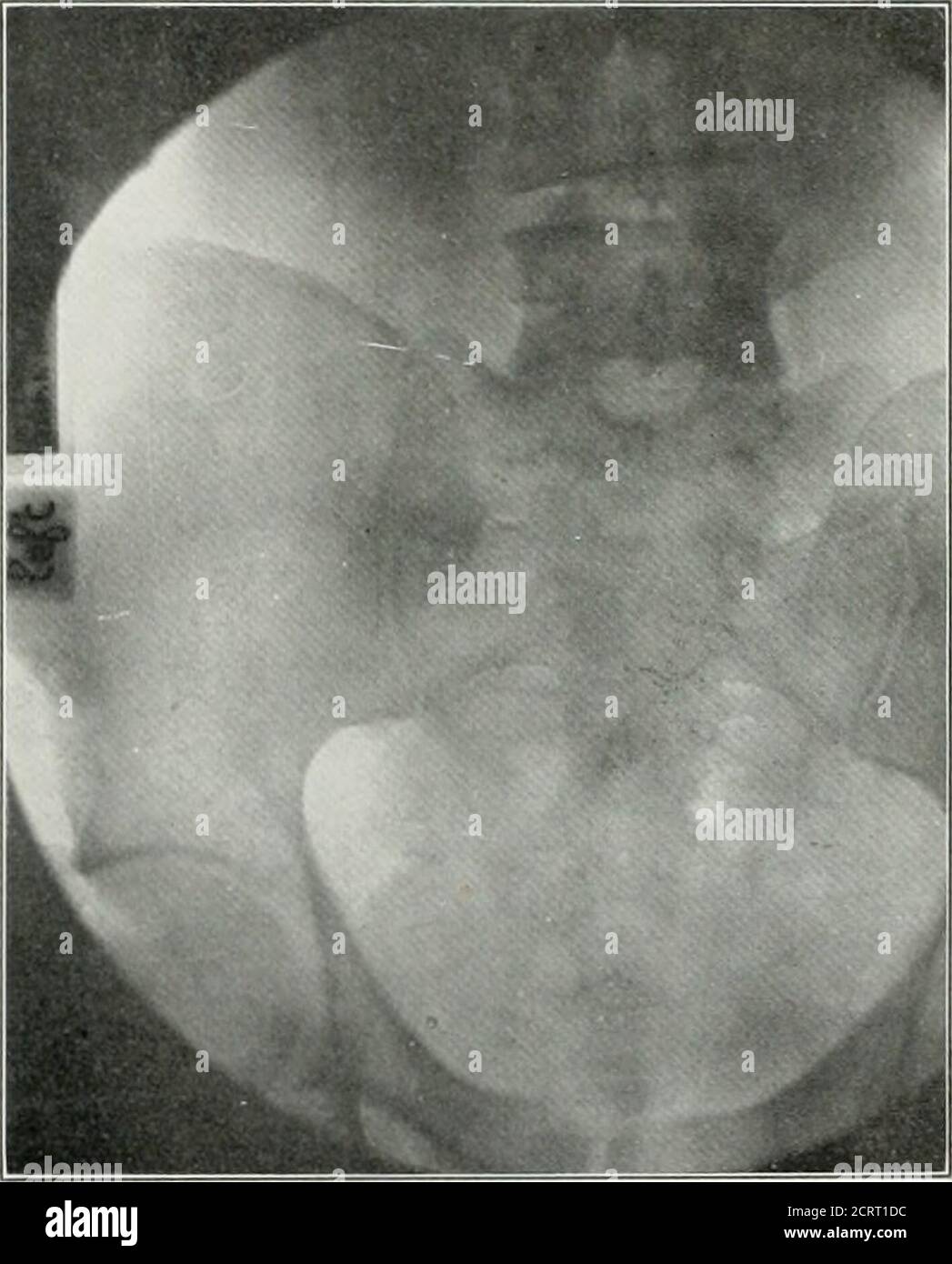 . The American journal of roentgenology, radium therapy and nuclear ...