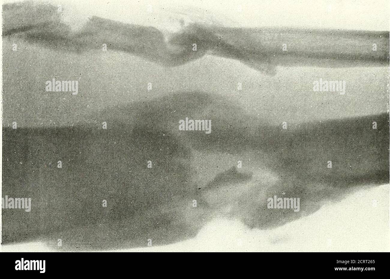 . On modern methods of treating fractures . Fig. -to.—The fracture ...