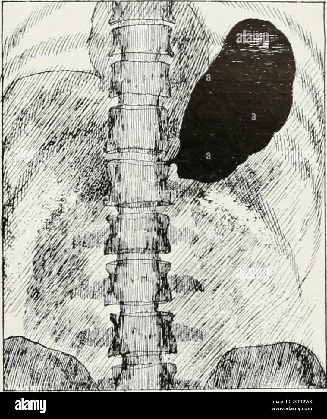 Gastric hernia hi-res stock photography and images - Alamy