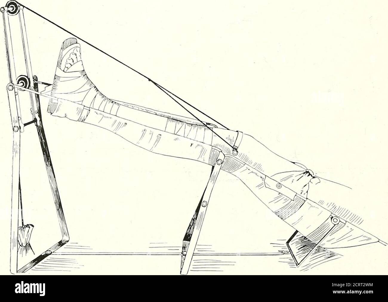 . On modern methods of treating fractures . l muscle spasm. Then ...