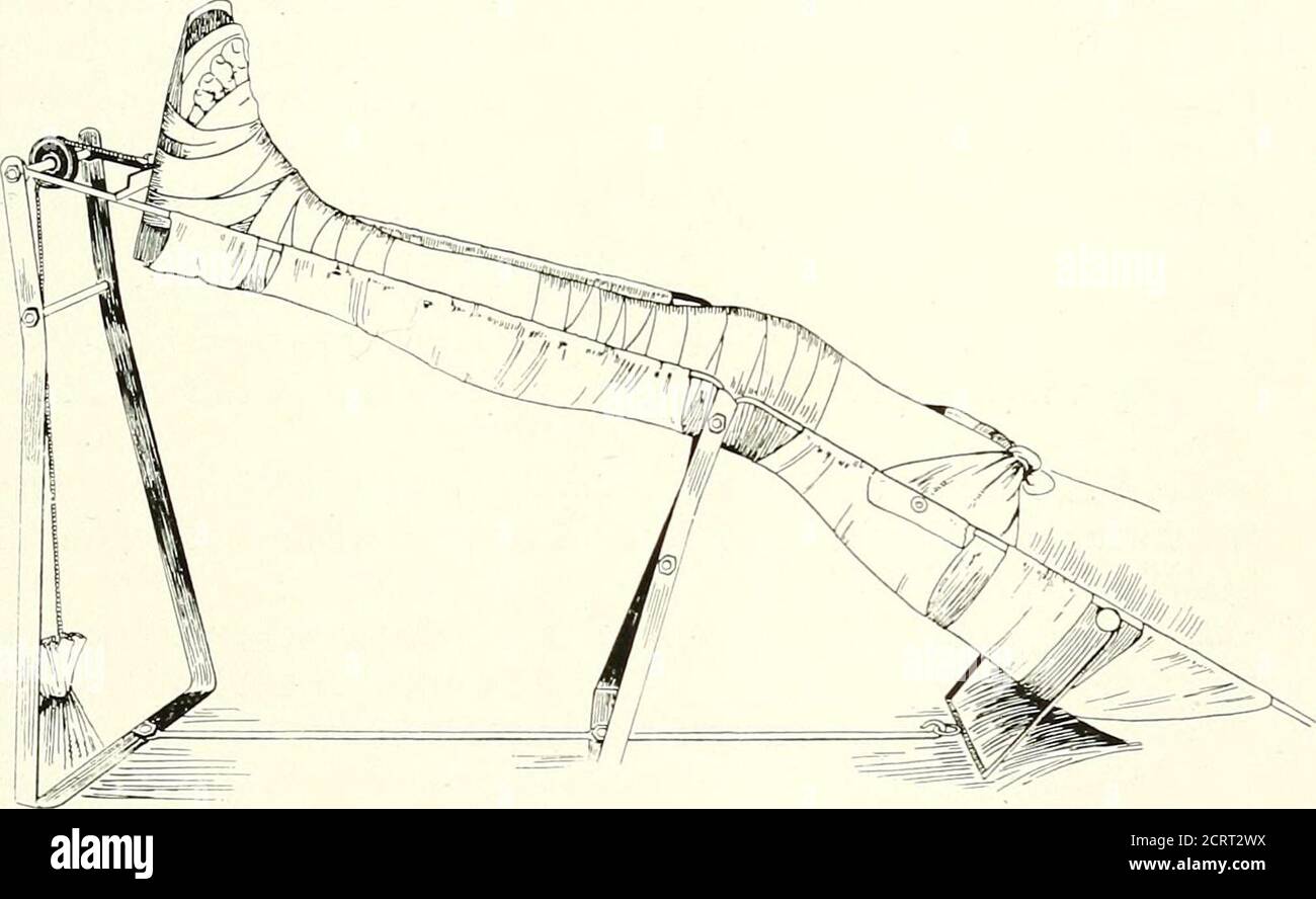 Frame broken leg hi-res stock photography and images - Alamy