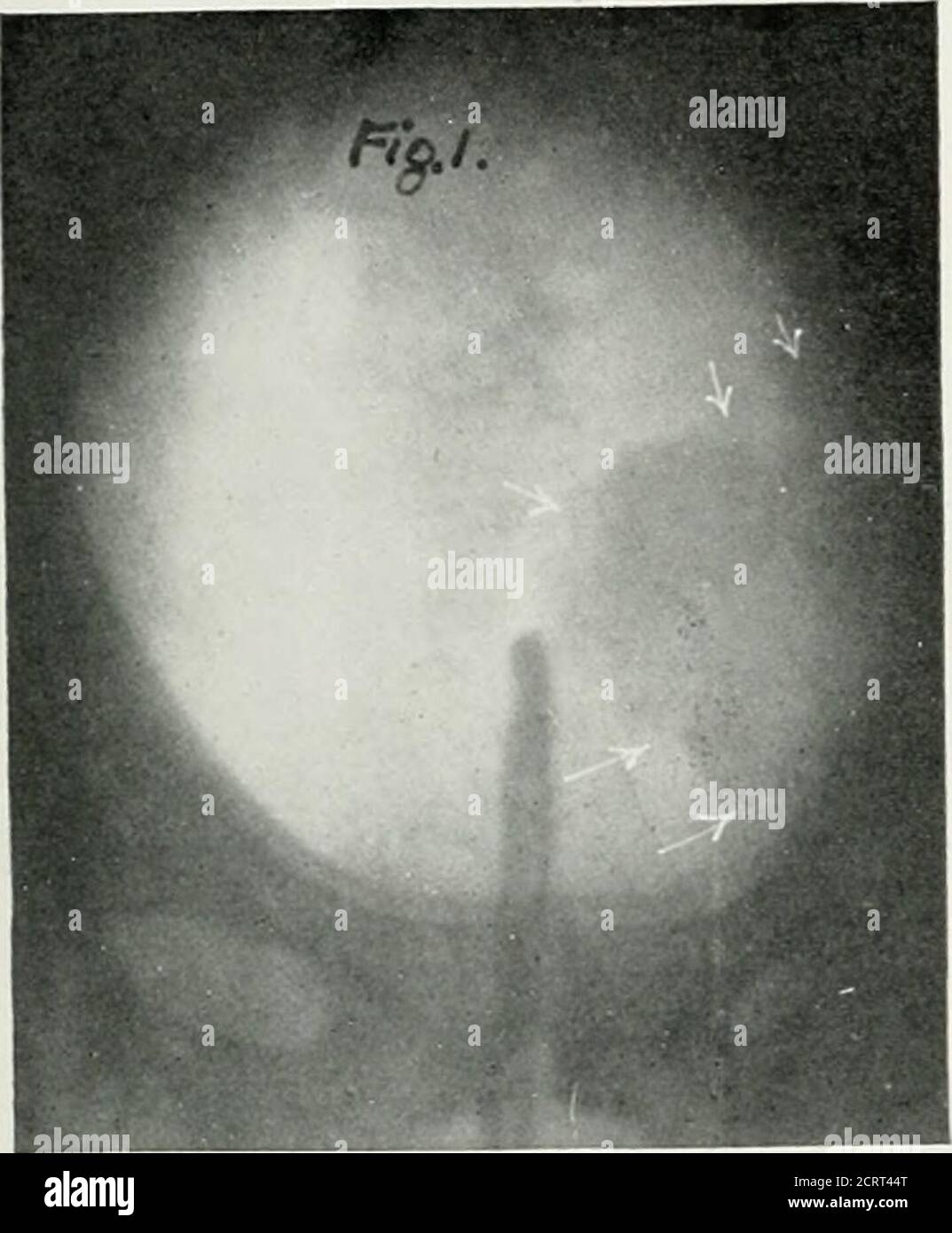 Nuclear medicine injection hi-res stock photography and images - Alamy