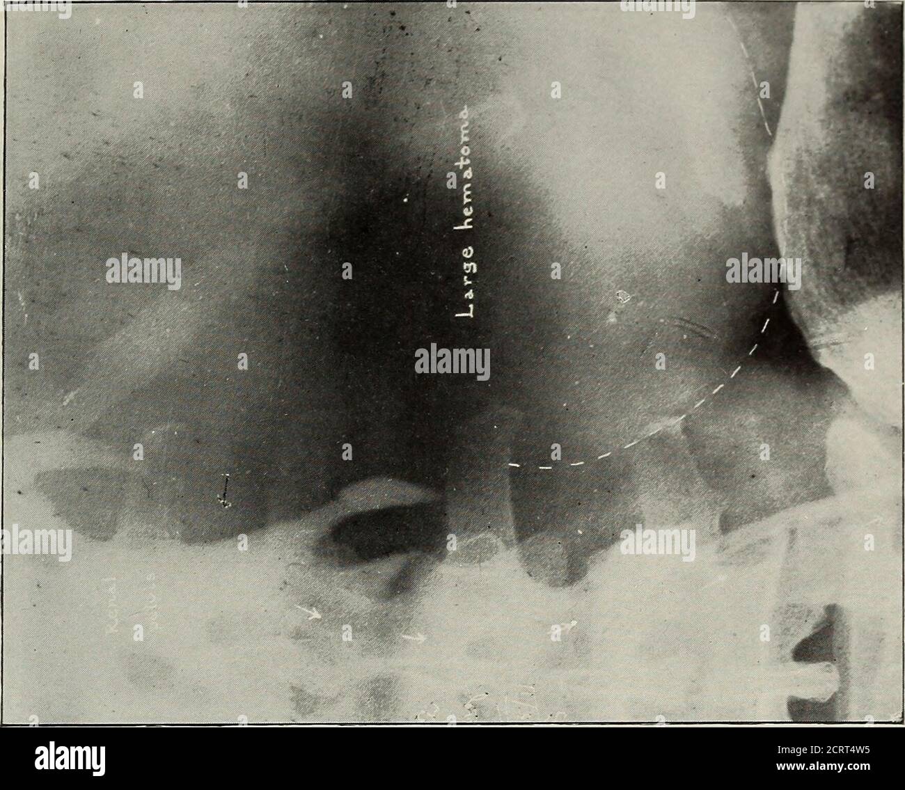 Appendicitis x ray hi-res stock photography and images - Alamy