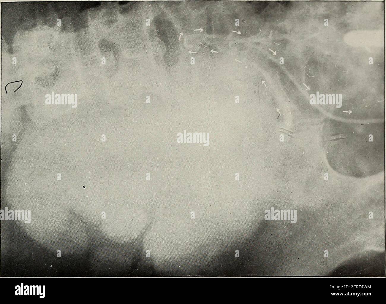 Hydronephrosis High Resolution Stock Photography and Images - Alamy