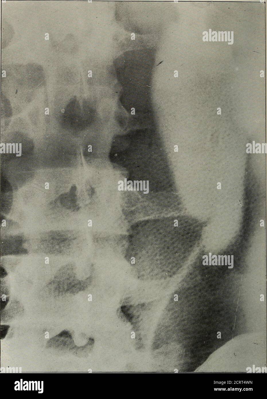 Hydronephrosis High Resolution Stock Photography and Images - Alamy