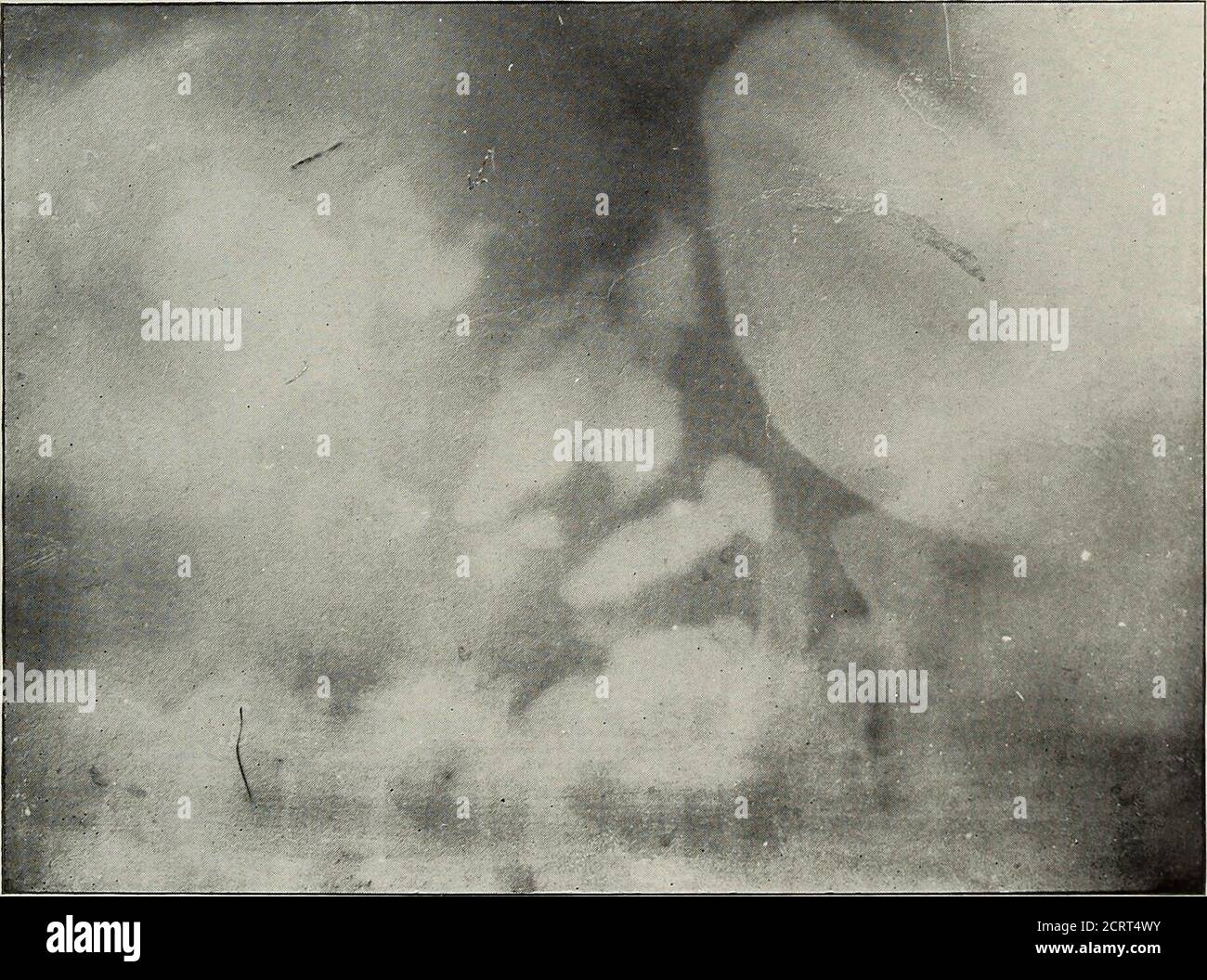 Appendicitis x ray hi-res stock photography and images - Alamy