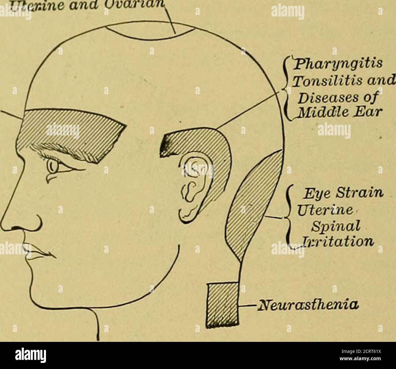 Spinal headaches hi-res stock photography and images - Alamy