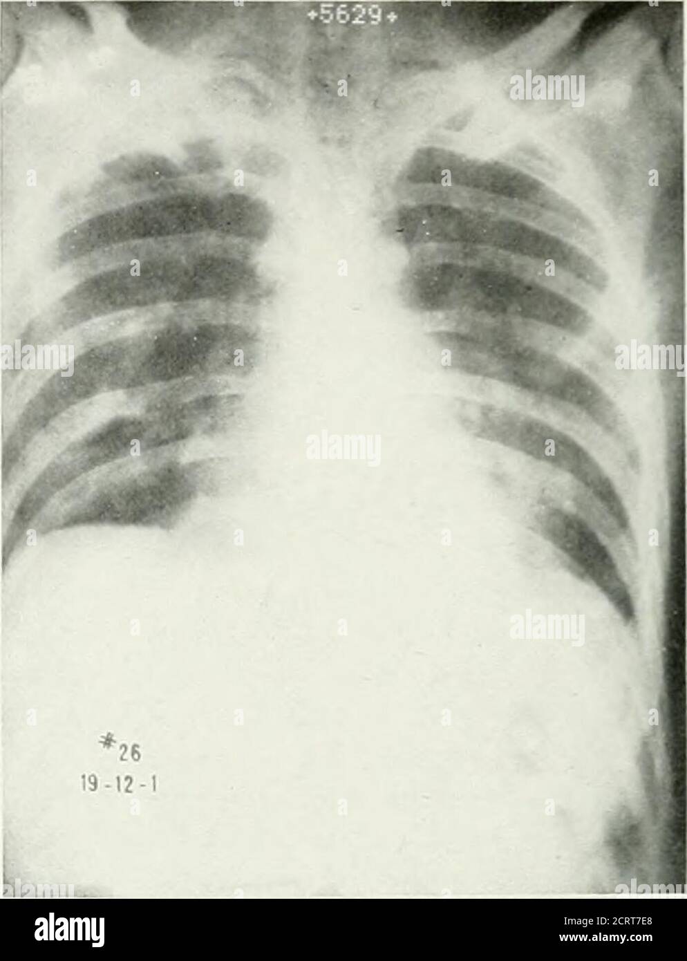 Pleuritis hi-res stock photography and images - Alamy